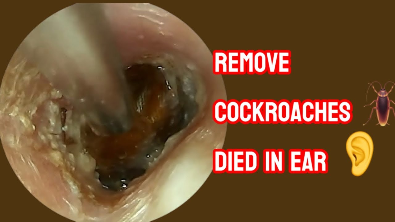 Remove cockroach 🪳 in ear - YouTube
