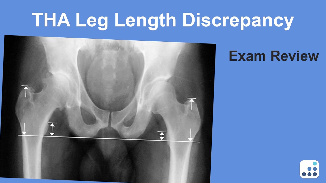 Leg Length Discrepancy - Daniel Berry, MD - YouTube