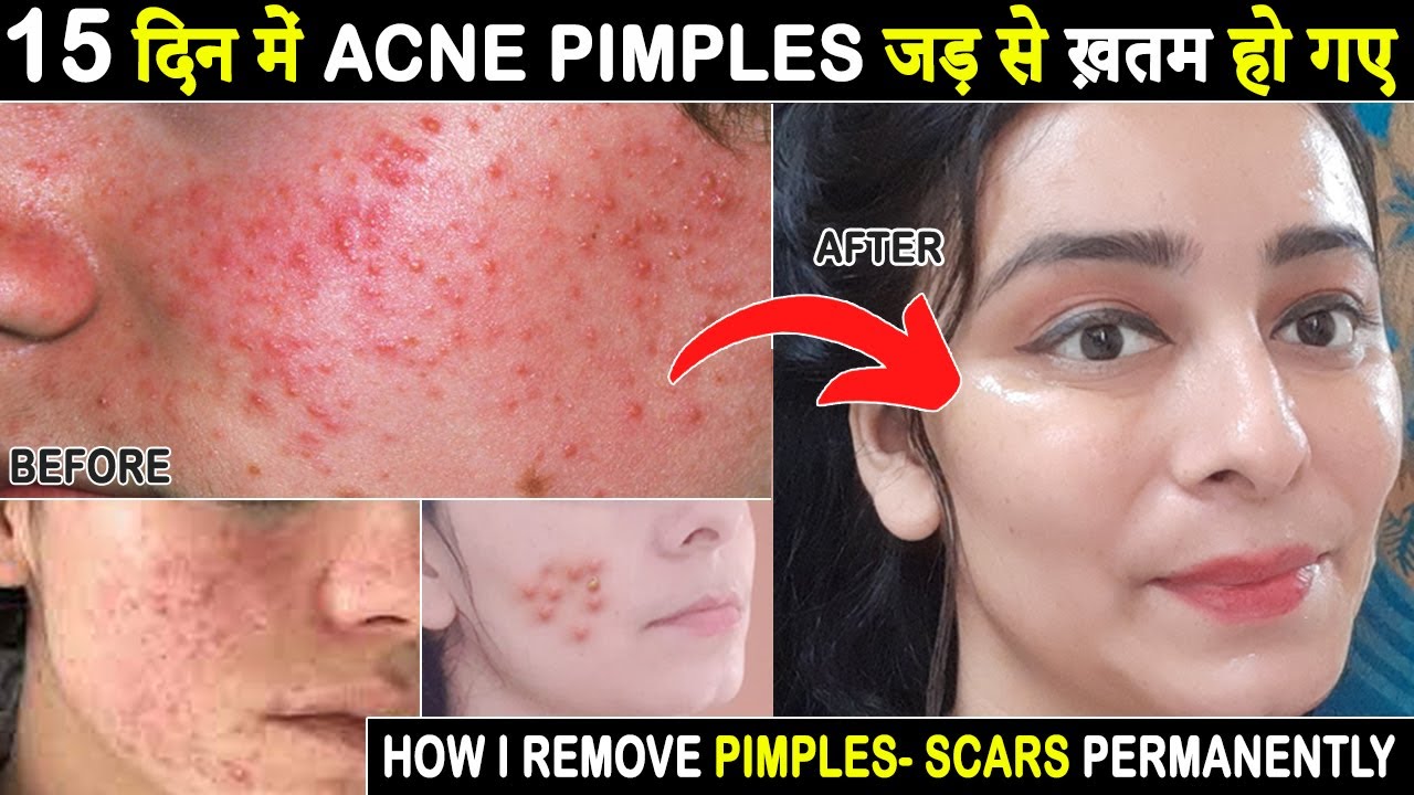 How I Remove Pimples Permanently |मेरे Acne Pimple जड़ से खतम हुए ...