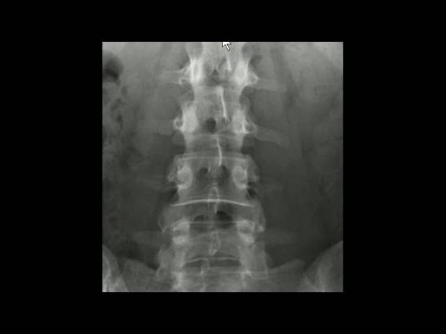 Raio X Da Coluna Cifotica Orto Center Clínica De Ortopedia Em