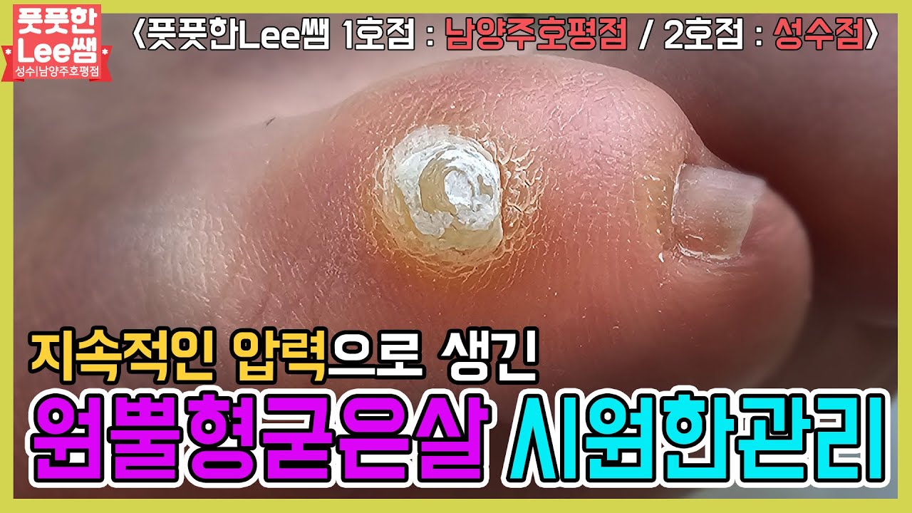 지속적인 압력으로 생긴 원뿔형 굳은살! 시원하게 관리해볼게요~ removing callus / foot scaling ...