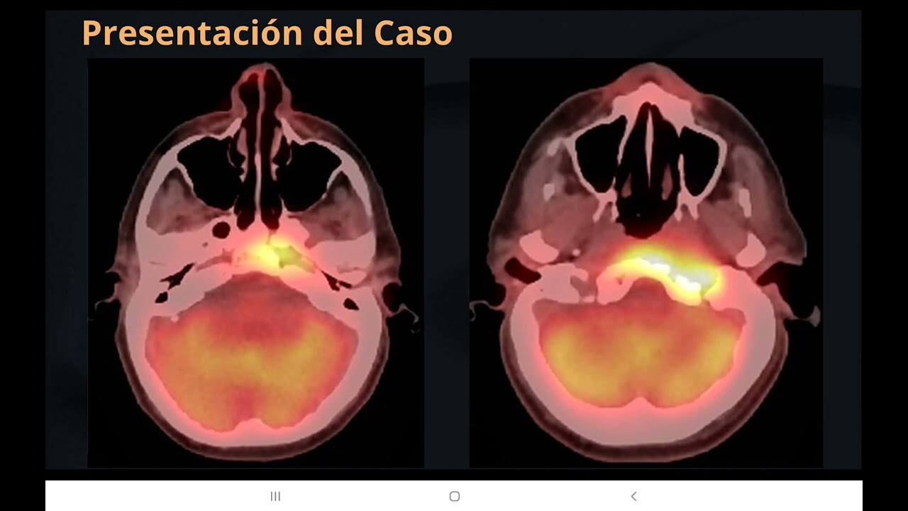 Caso del Mes n°111 Septiembre 2022, “Síndrome de Collet Sicard” Dr ...