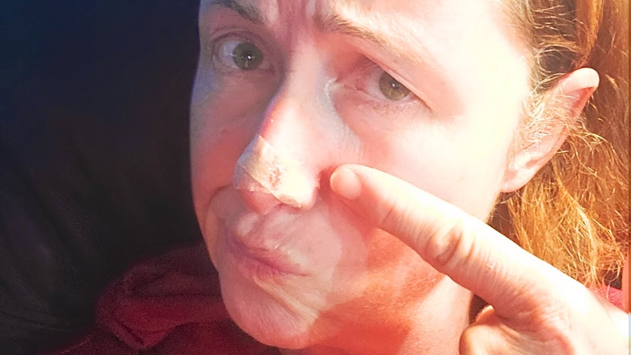 Nose Skin Cancer Means Biopsy And Efudexfluorouracil Treatment Episode 61 Youtube