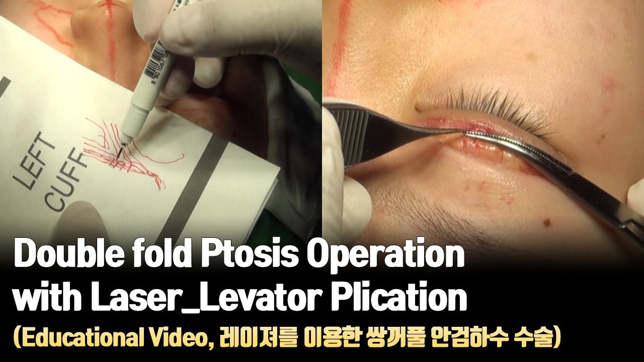 Double fold Ptosis Operation with Laser_Levator Plication(Educational ...