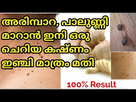 100% Effective അരിമ്പാറ വേരോടെ മാറും#arimpara removal malayalam//how to ...