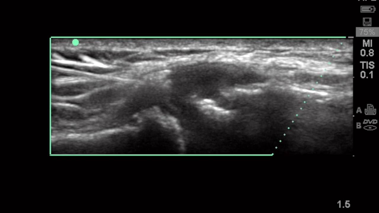 ACJ injection lateral approach - YouTube