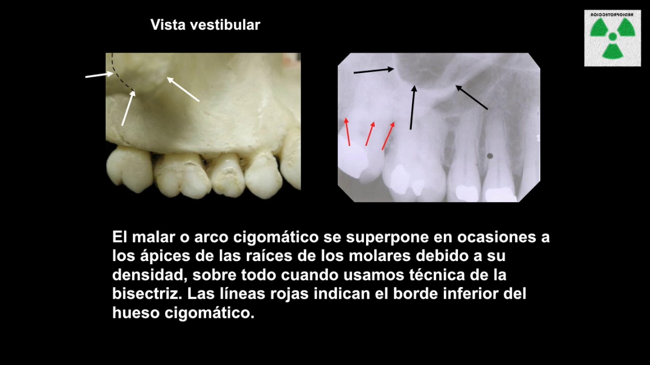 Anatomía radiológica Maxilar y mandibular - YouTube