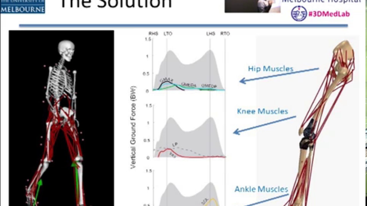 A Computer-Based Model of Above Knee Amputees to Evaluate Gait ...