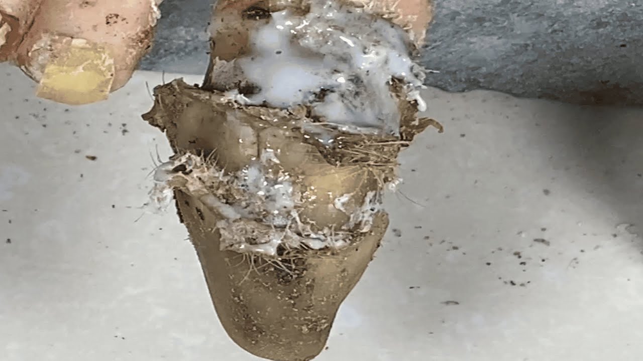 Sharp Ingrown Toenails Trimmed! Professional Pedicure There Is A Lot Of ...