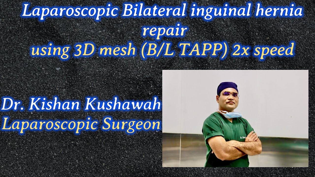 Laparoscopic Bilateral inguinal hernia repair(TAPP) with 3Dmesh - 2X ...