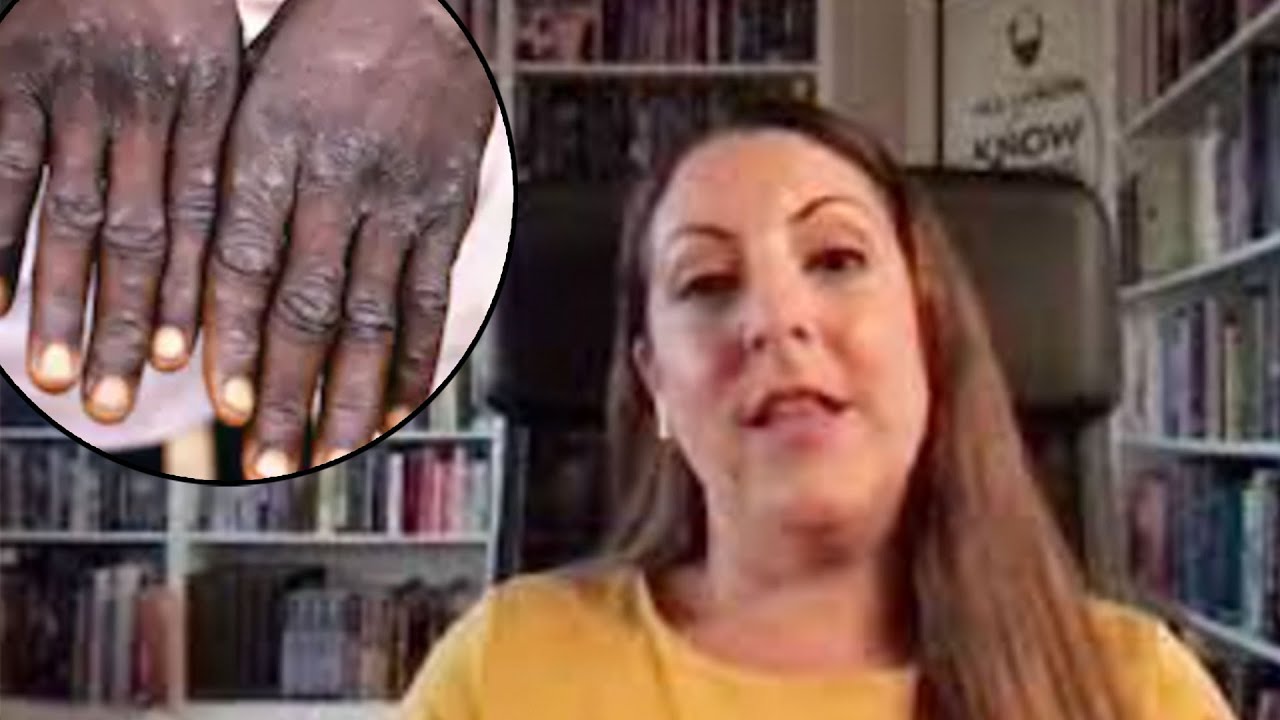 Apkoppor: Så smittar sjukdomen • Virus • Feber • Blåsor - YouTube