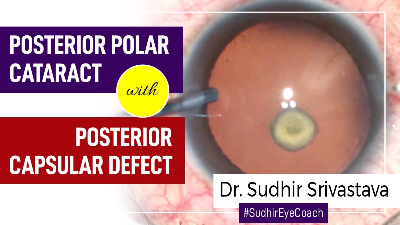 Posterior polar cataract with posterior capsular defect # ...