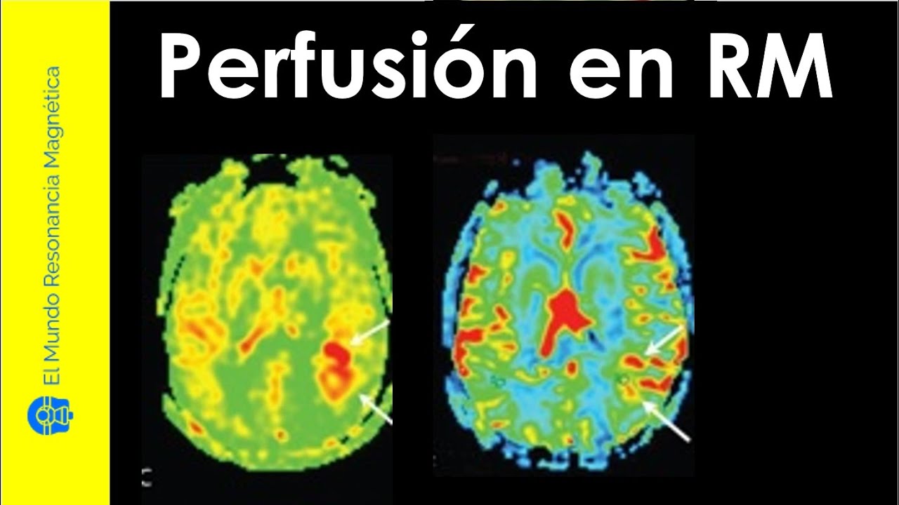 Vídeo 21 PERFUSIÓN CEREBRAL por Resonancia Magnética. Secuencias T2 ...