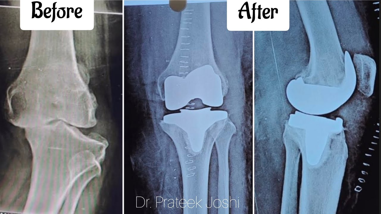 Knee Replacement Surgery in Severe Varus Deformity | Dr. Prateek Joshi ...