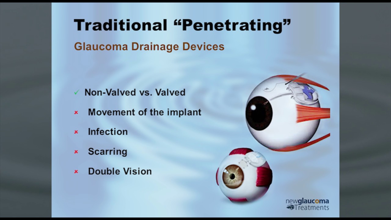 Trabeculectomy and Glaucoma Drainage Devices for Glaucoma - YouTube