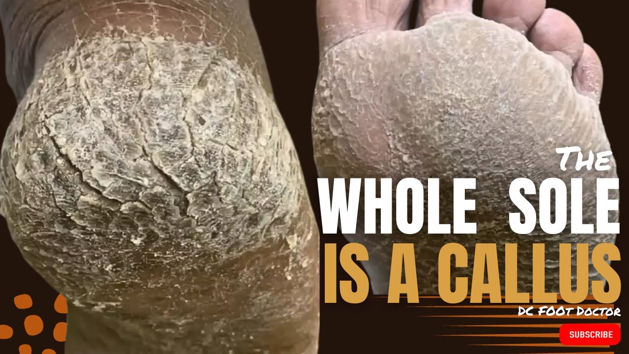 The Whole Sole Is Callused! - YouTube