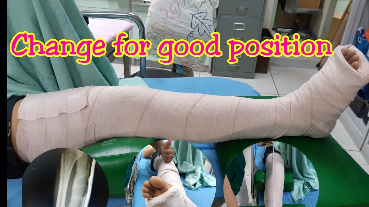 Change Long leg slab case fx. BB. of leg with wrong position - YouTube