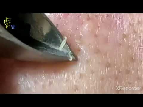 Rahatlatıcı Sivilce ve Siyah Nokta Sıkma Videoları (تهدئة البثور والرؤوس السوداء الفيديو.)😲😲😲 @ANSPA