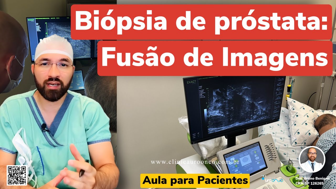 Avanços na Biópsia de Próstata: A Nova Era da Precisão Diagnóstica com ...