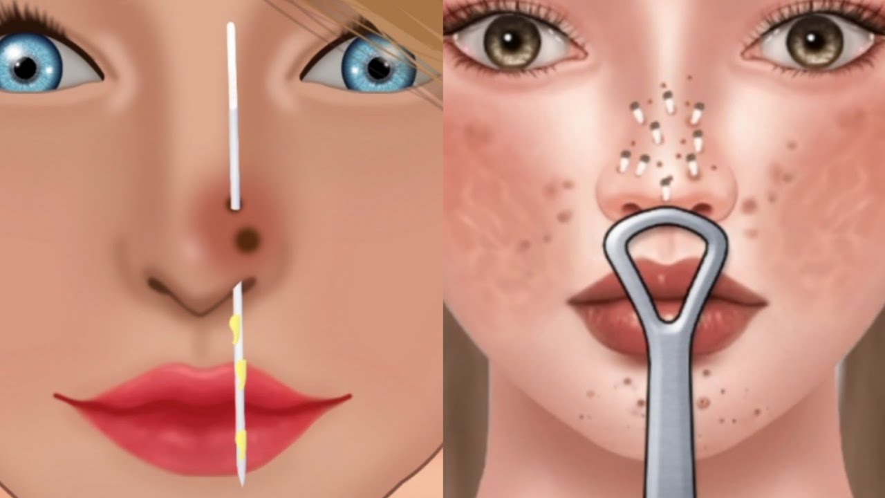 ASMR Remove Face Acne Blackhead & Nose Piercing Infected Treatment ASMR ...