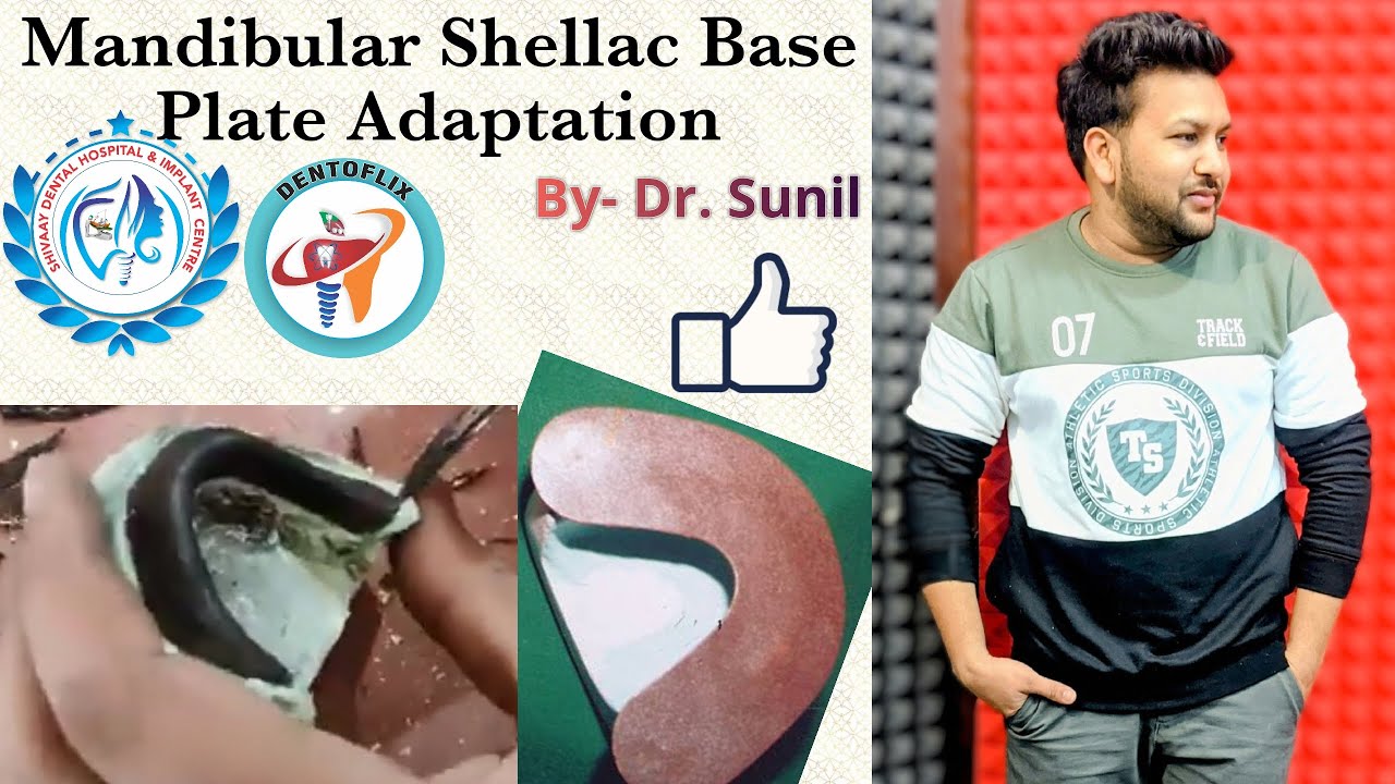 Preclinical Prosthodontics: Mandibular Shellac Base Plate Adaptation ...