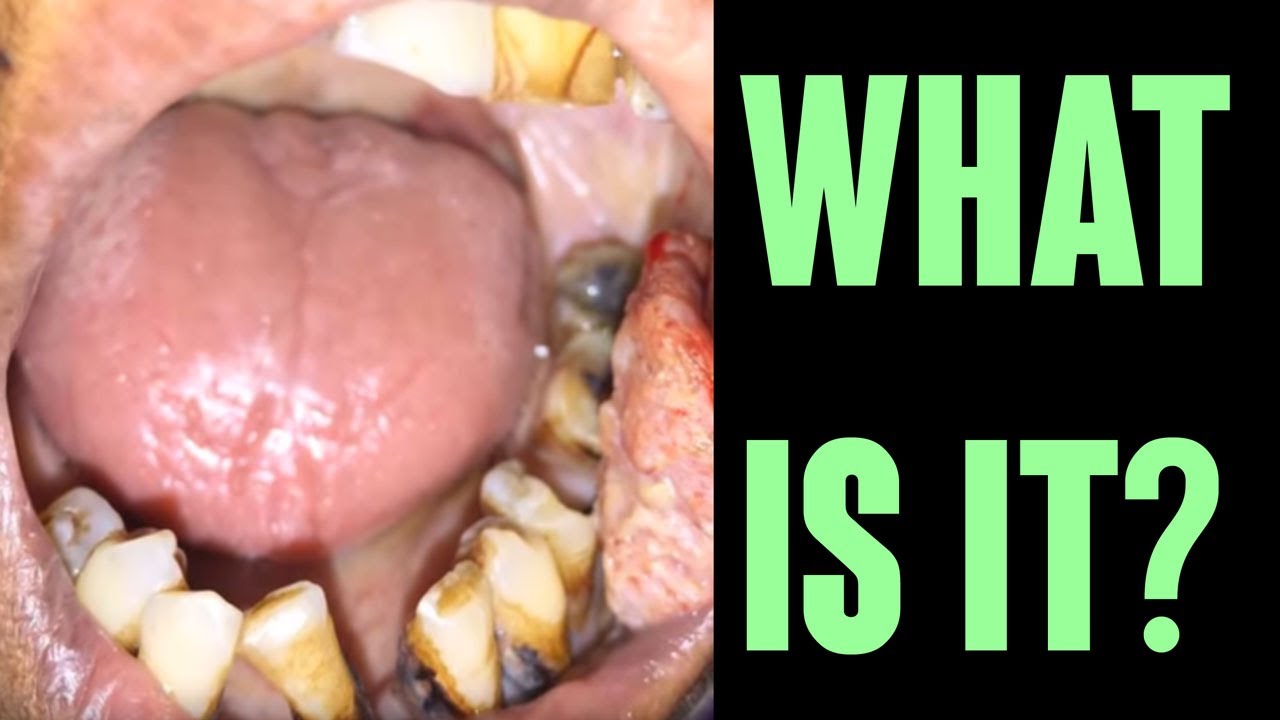 Massive Growth In Mouth What Is It YouTube massive-growth-in-mouth-what-is-it-youtube