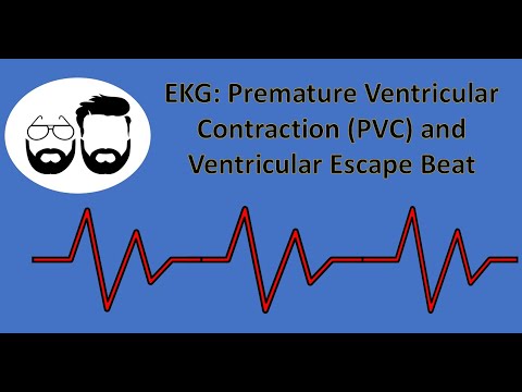 EKG Series: Premature Ventricular Contraction (PVC) and Ventricular ...