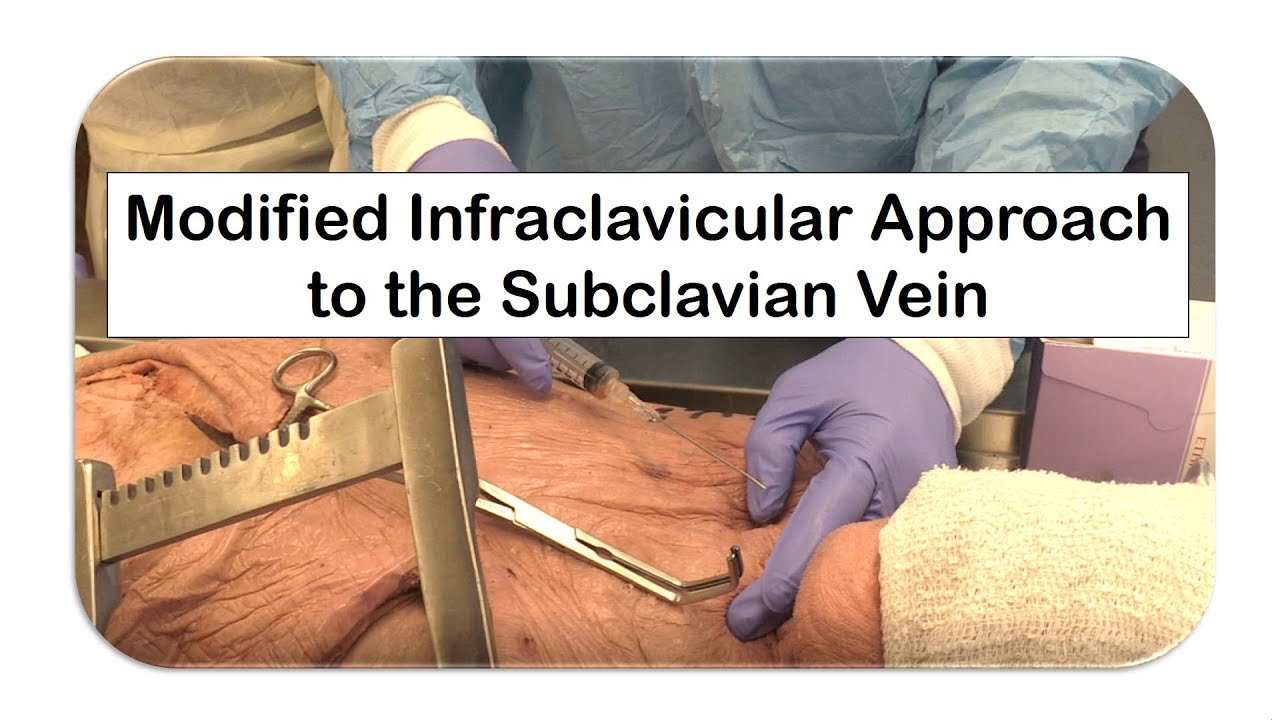 Modified Infraclavicular Approach to the Subclavian Vein - YouTube