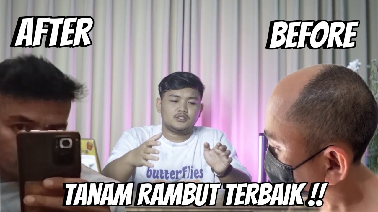 before after tanam rambut terbaik sepanjang masa !! - YouTube