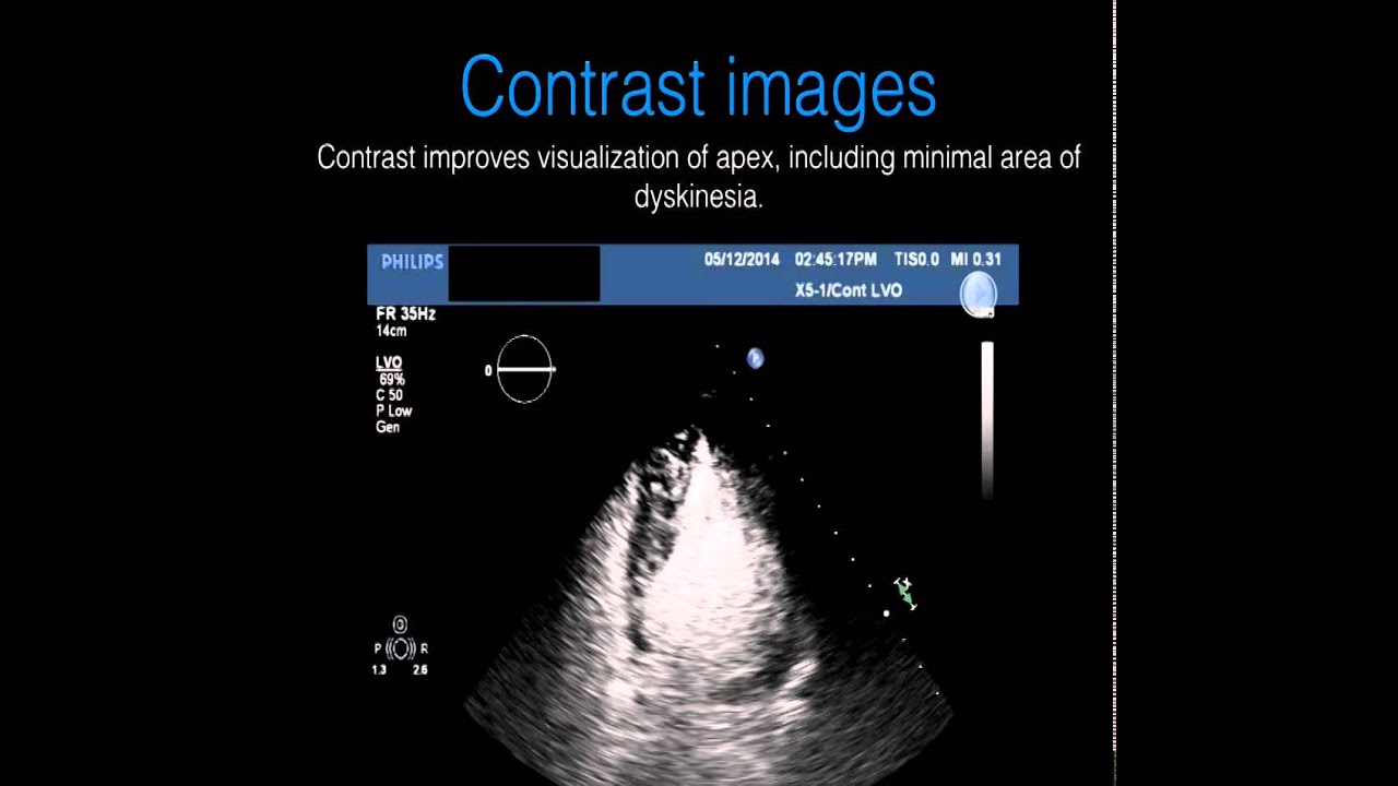 Apical HCM Converted - YouTube