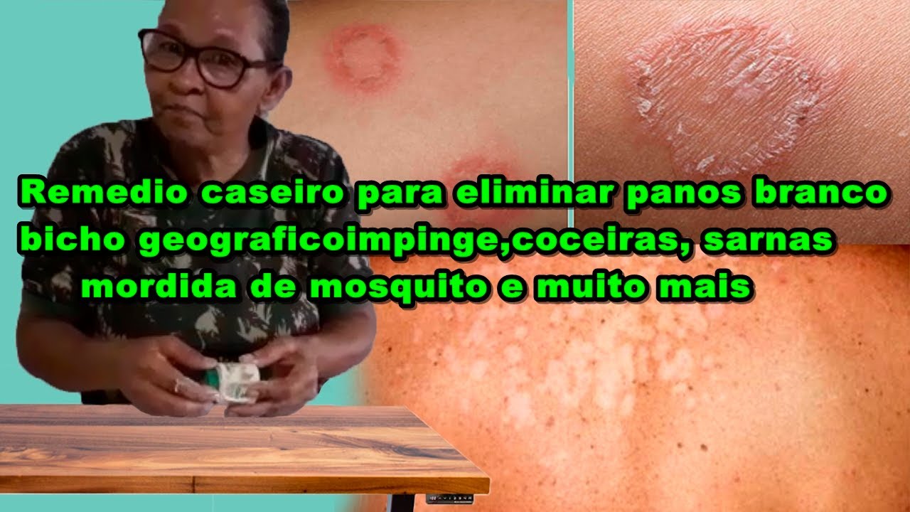 Remedio caseiro para eliminar panos branco,bicho geografico,impinge ...