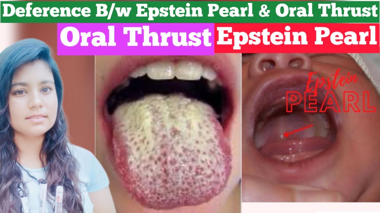 Difference Between Oral Thrust and Epstein Pearls || Oral Thrust ...