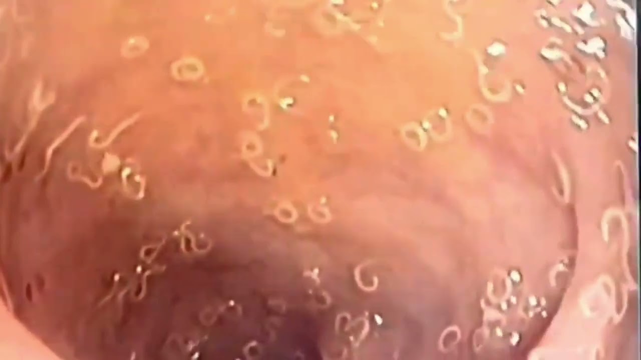 Intestinal worms during colonoscopy - YouTube