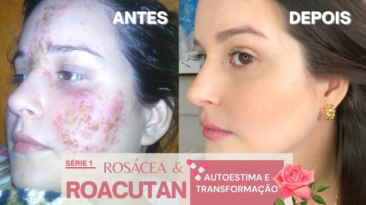 Tratamento com o ROACUTAN funciona? - Rosácea - YouTube