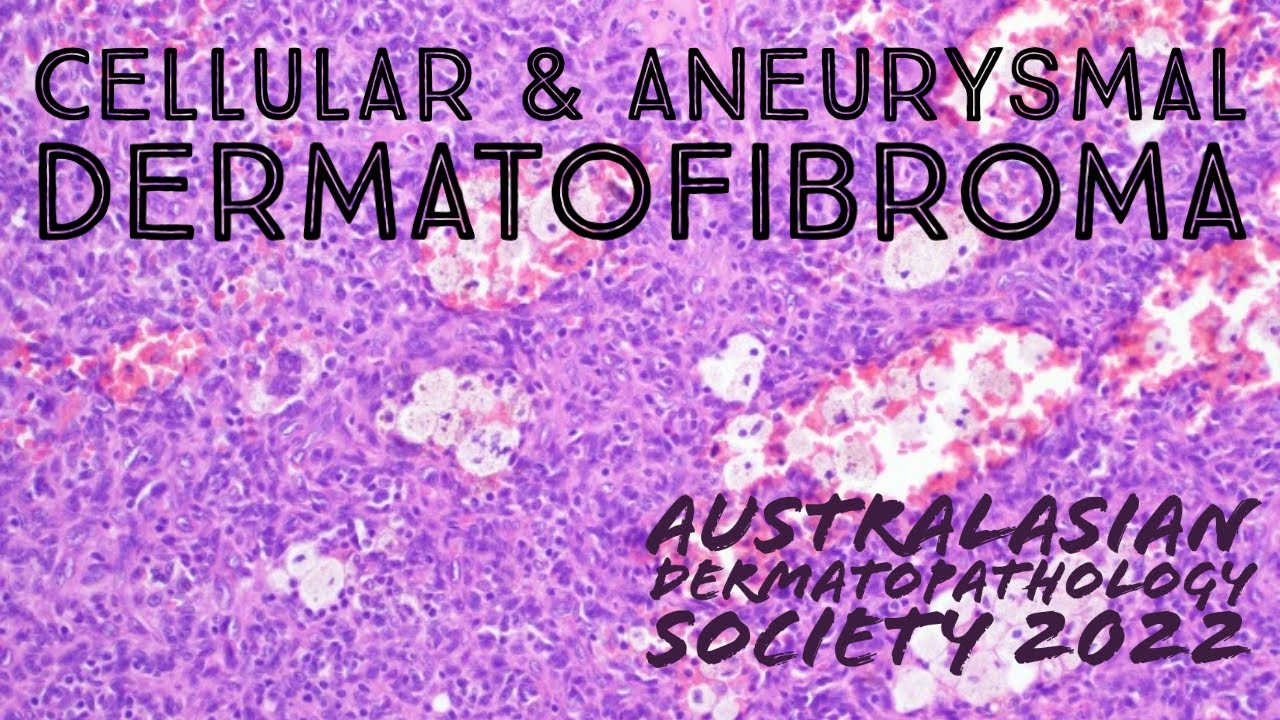 Cellular Dermatofibroma & Aneurysmal Dermatofibroma 101 (pathology ...