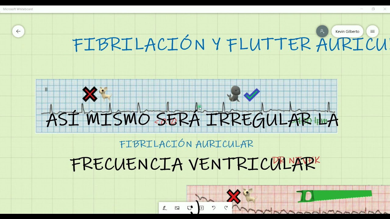 Fibrilación y Flutter Auricular - YouTube