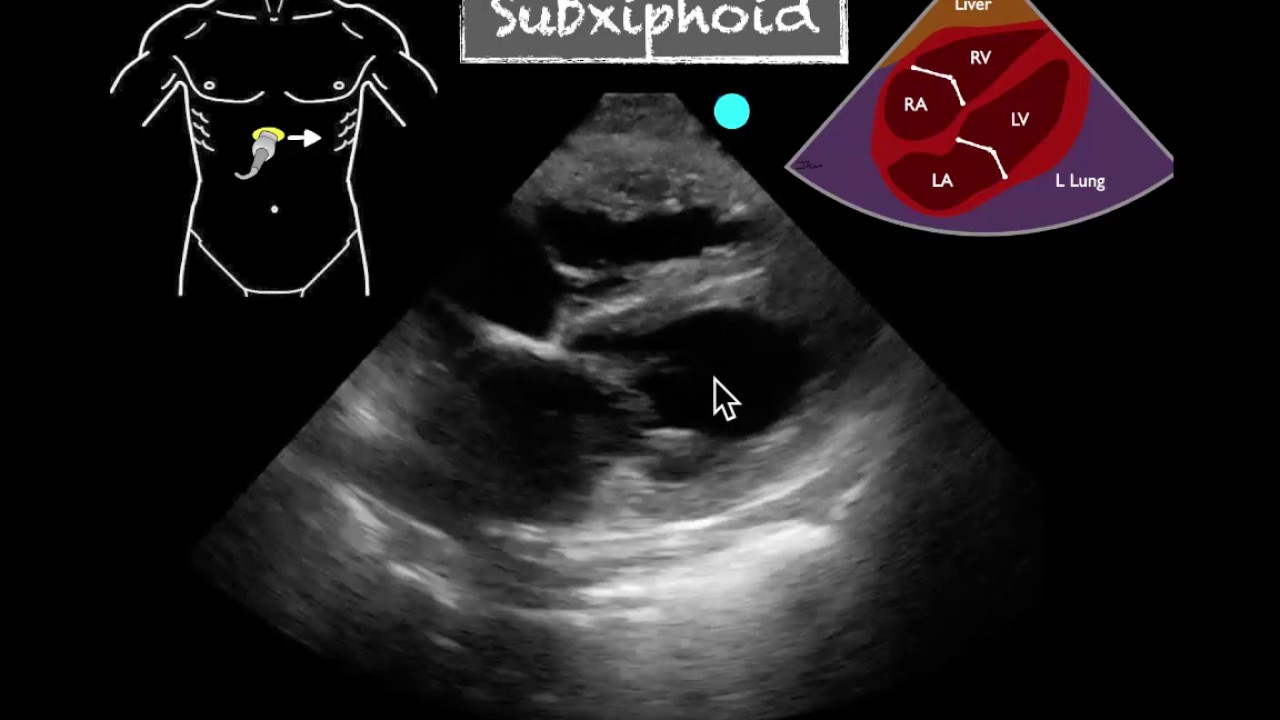 POCUS Cardiac Subxiphoid Severely Reduced EF - YouTube