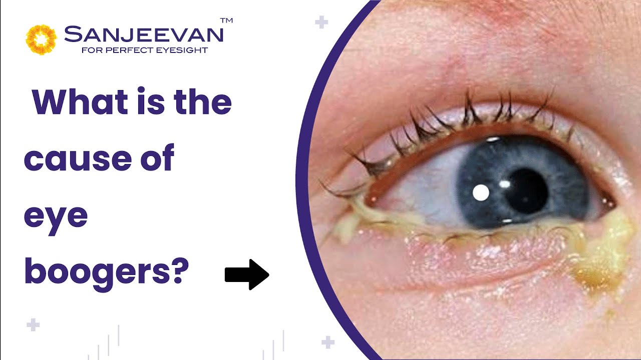 What are the Cause Of Eye Boogers? | Explained | Seek Help | Visit ...