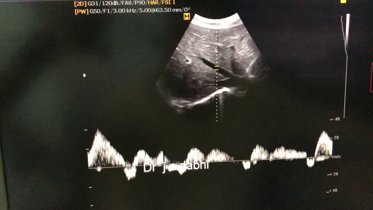 Normal Hepatic vein doppler ultrasound - YouTube