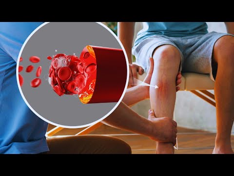 Understanding Deep Vein Thrombosisy (DVT): An Animated Guide - YouTube