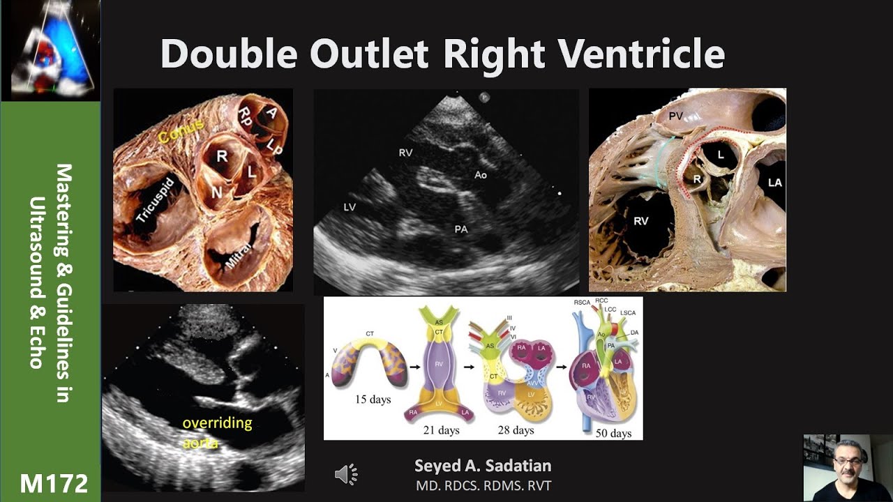 Double Outlet Right Ventricle (DORV) - YouTube