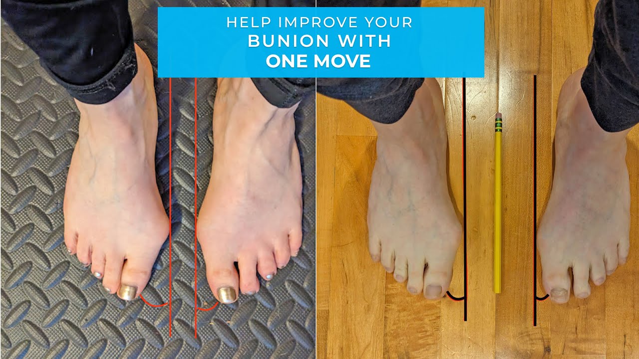 Help Improve Your Bunion With One Move - YouTube