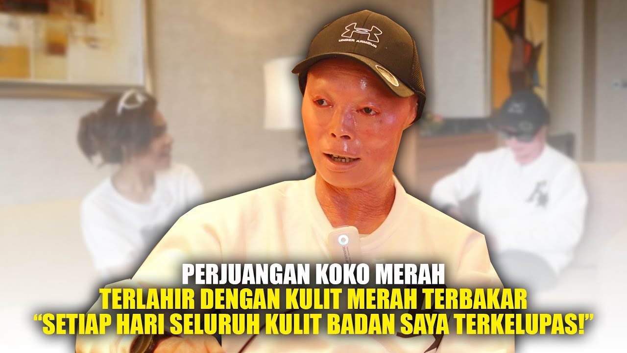 KOKO MERAH "SETIAP HARI SELURUH KULIT BADAN SAYA TERKELUPAS!" - YouTube