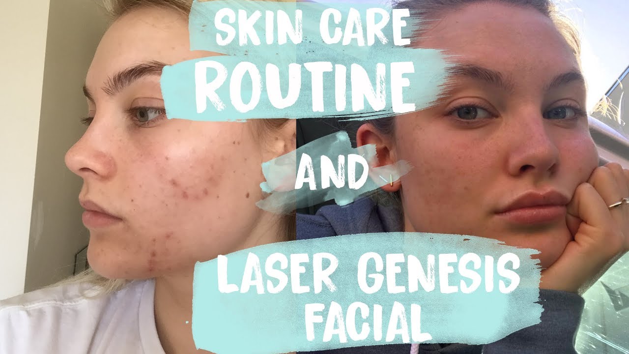 SKIN CARE ROUTINE | LASER GENESIS FACIAL - YouTube