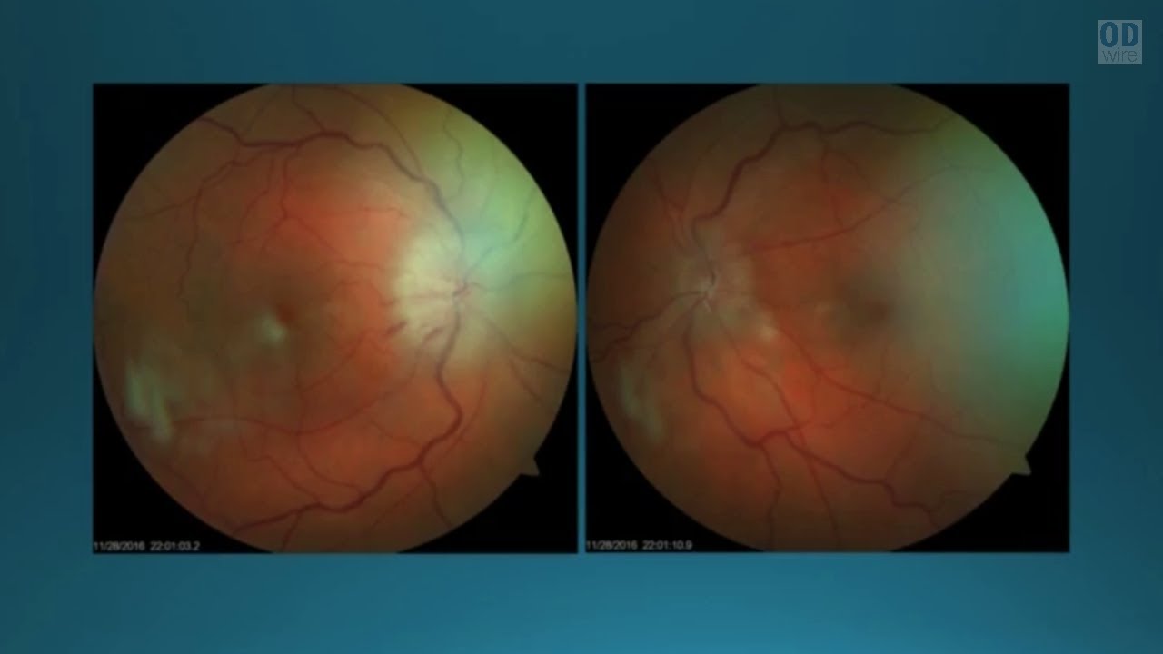 Grand Rounds: Neuro-Ophthalmology and Systemic Disease - YouTube