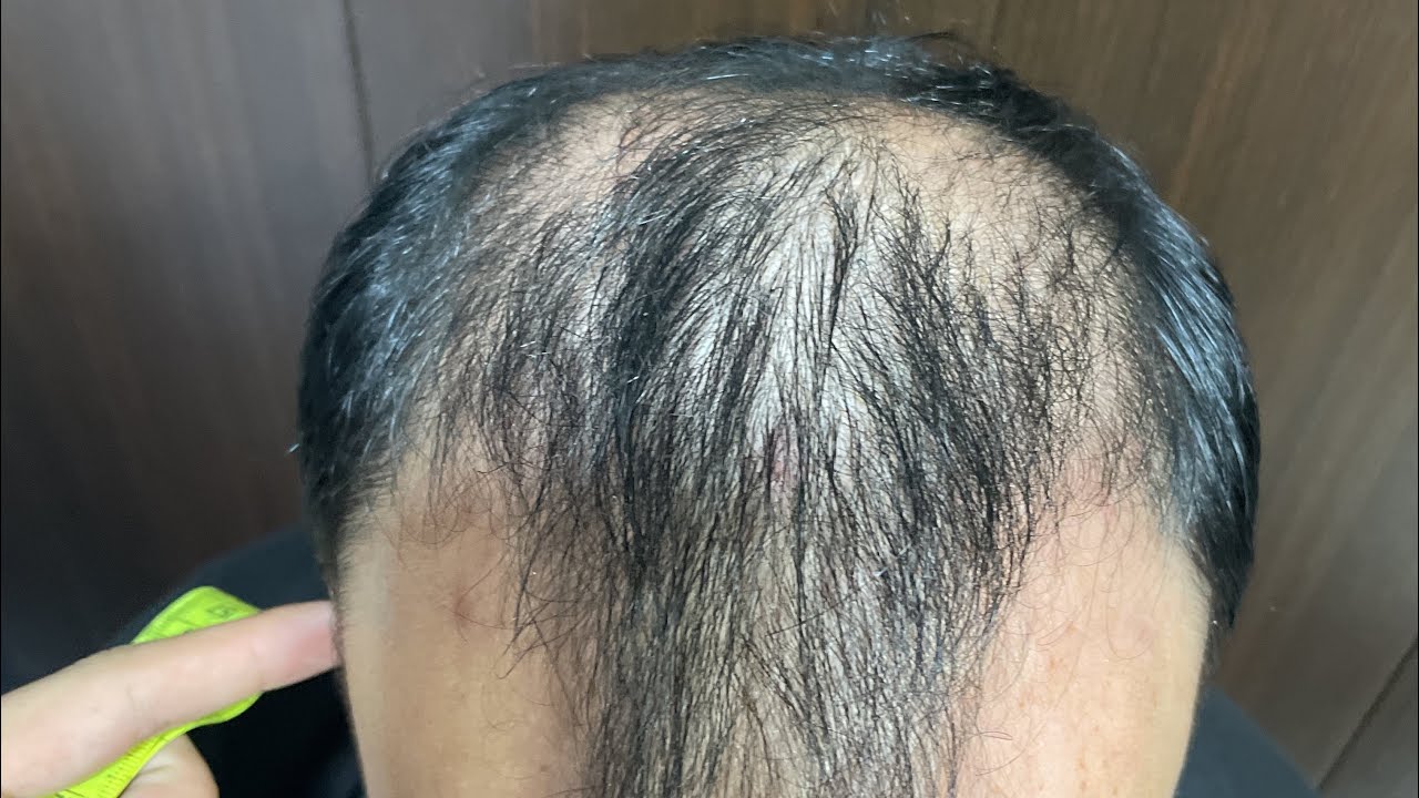 Protez soch yopishtirish ,ekish , soch tokilishidan xavotir olmang ...