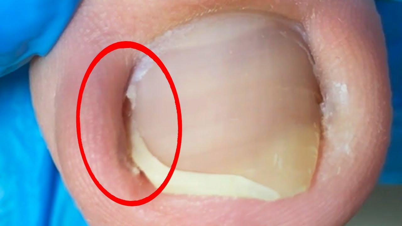 Ingrown Toenail With Inflammation At The Root, Completely Removed【Crazy ...