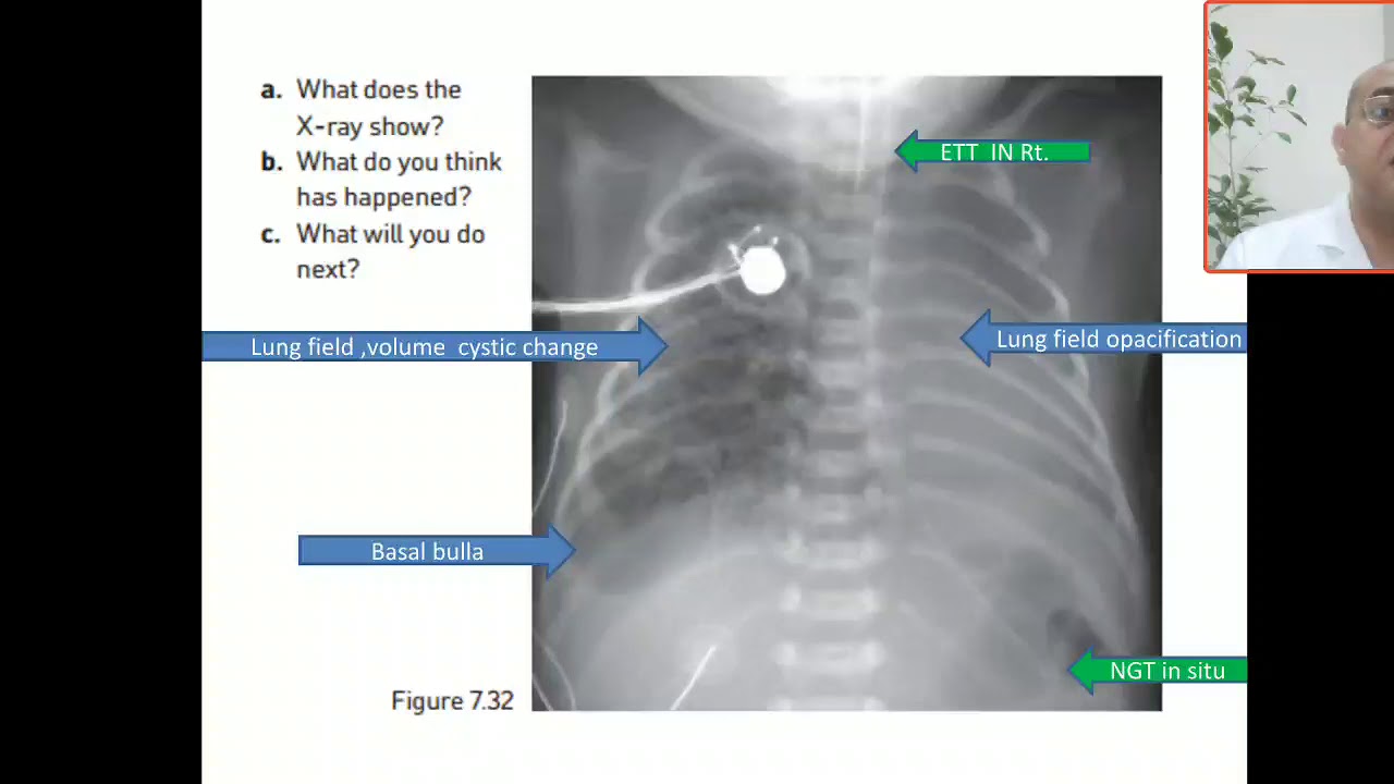 Case 112 common hidden morbidity in NICU, iatrogenic disease, ETT ...