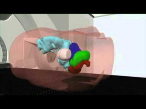 Intensity Modulated Radiotherapy (IMRT) - YouTube