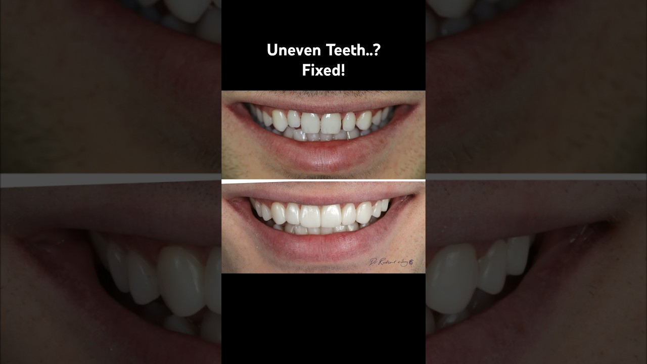 How to Improve Uneven Teeth with Veneers, SMILE MAKEOVERS Australia ...